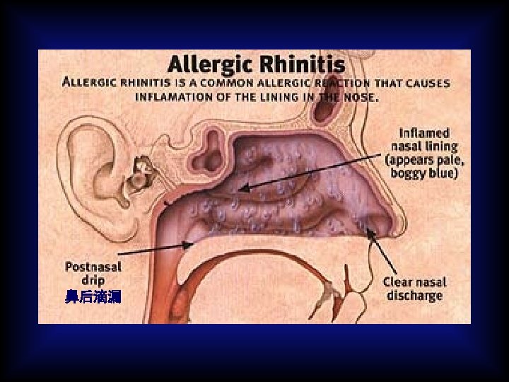 Nasal mucosal hyperreactive rhinopathy Allergic Rhinitis AR PerennialPAR