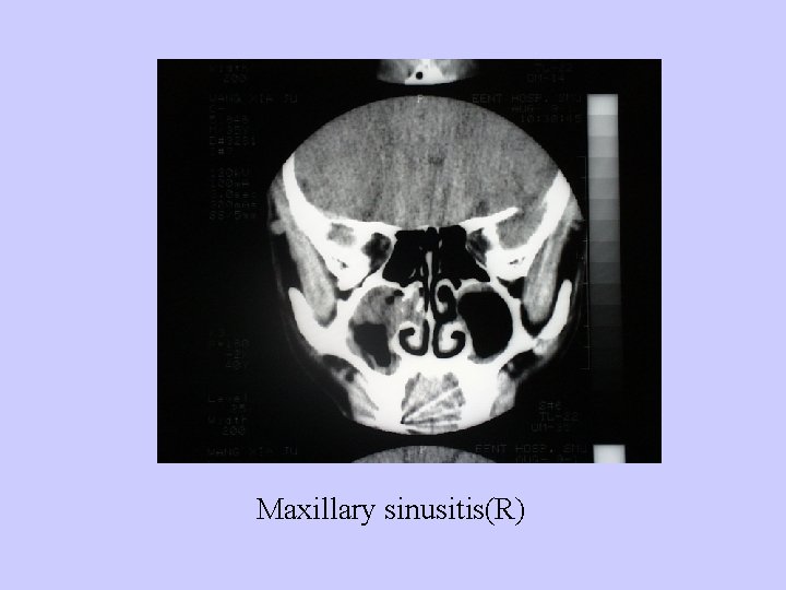 Nasal mucosal hyperreactive rhinopathy Allergic Rhinitis AR PerennialPAR