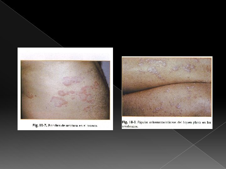 Lesiones primarias FUNCIONES DE LA PIEL Histologa Epidermis