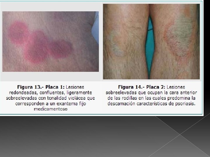 Lesiones primarias FUNCIONES DE LA PIEL Histologa Epidermis