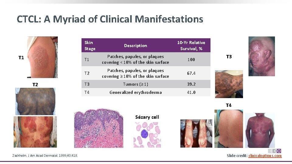 New Systemic Therapies for Mycosis Fungoides and Szary