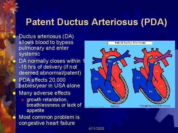 Patent Ductus Arteriosus Occlusion Device Oral Presentation 4