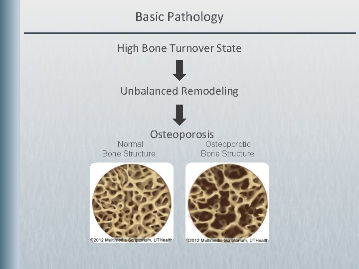 Osteoporosis Educational Series Treatment and Prevention Nahid Rianon