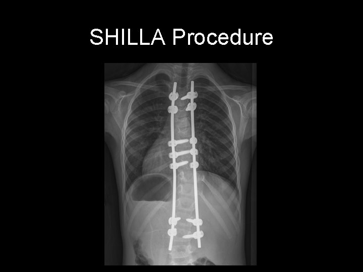 IDIOPATHIC SCOLIOSIS Dr Samir Al sayegh Consultant Pediatric