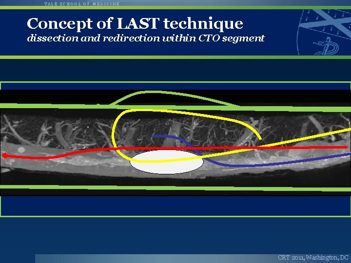 Crossing CTOs via Planned Dissection La ST Limited