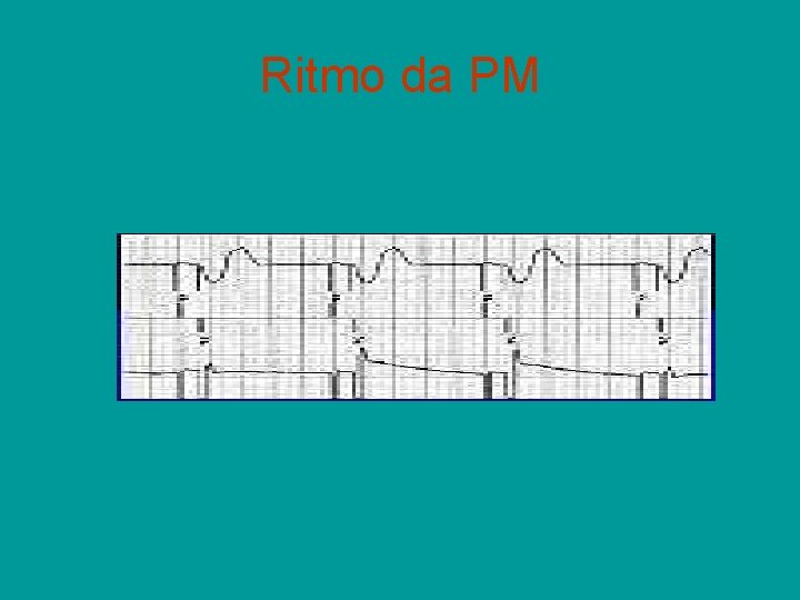 Pacemaker temporaneo Il PaceMaker Il PM un apparecchio