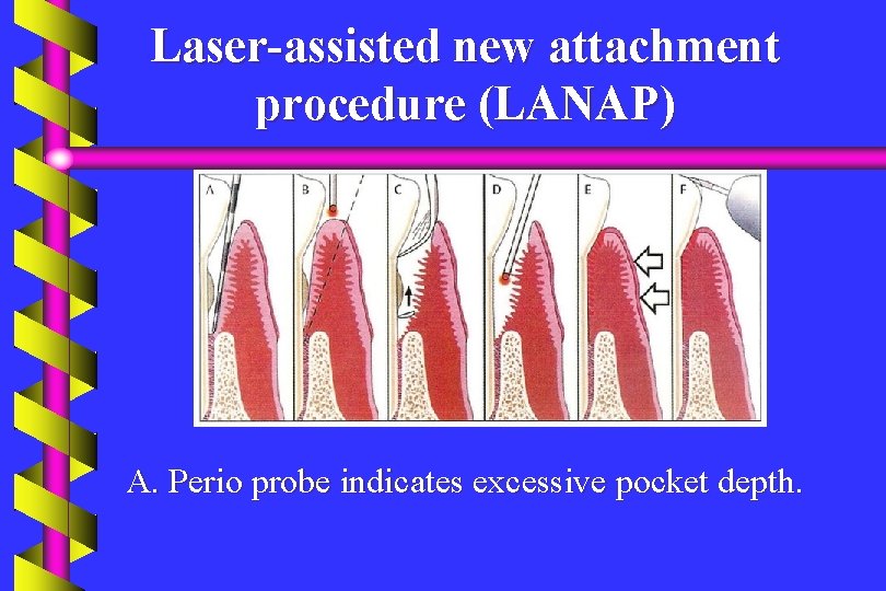Clinical applications of laser in periodontology b Gingivoplasty