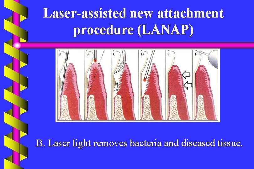Clinical applications of laser in periodontology b Gingivoplasty
