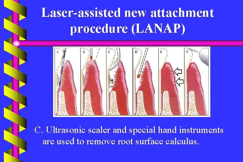 Clinical applications of laser in periodontology b Gingivoplasty