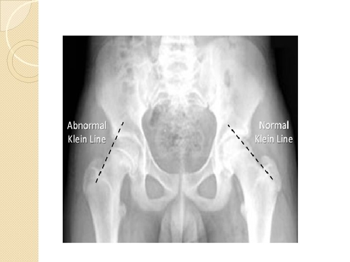 Slipped capital femoral epiphysis SCFE or skiffy slipped
