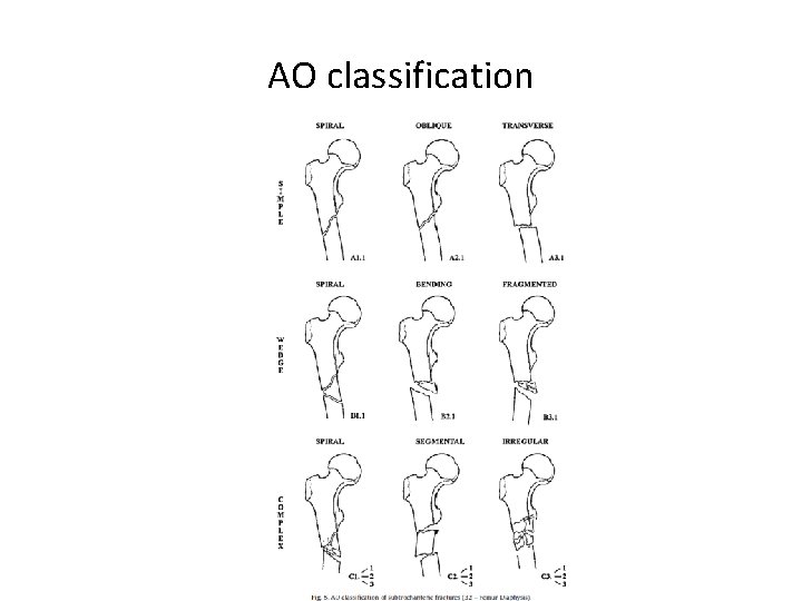 SUBTROCHANTERIC FEMUR FRACTURES Dr Sudhir Rawat Associate Professor