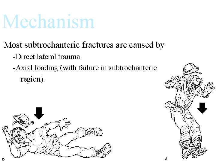 SUBTROCHANTERIC FEMUR FRACTURES Dr Sudhir Rawat Associate Professor