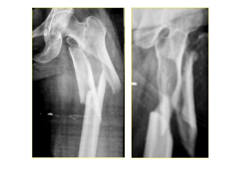 SUBTROCHANTERIC FEMUR FRACTURES Dr Sudhir Rawat Associate Professor