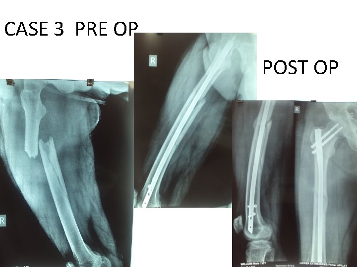 SUBTROCHANTERIC FEMUR FRACTURES Dr Sudhir Rawat Associate Professor