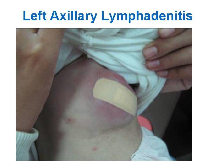 Bacille CalmetteGuerin VaccineInduced Disease in Children with HIVAIDS