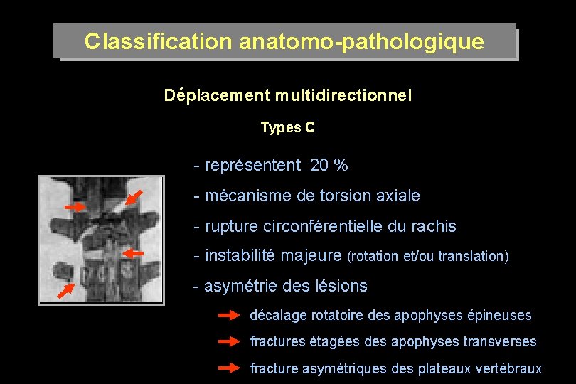 Les fractures du rachis dorsal Samir KHOURY DES