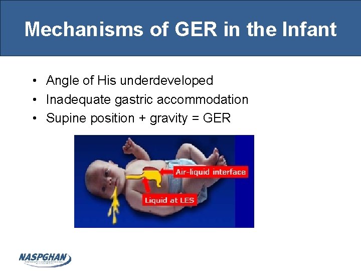 Gastroesophageal Reflux in Infants Lindsey Albenberg DO Andrew