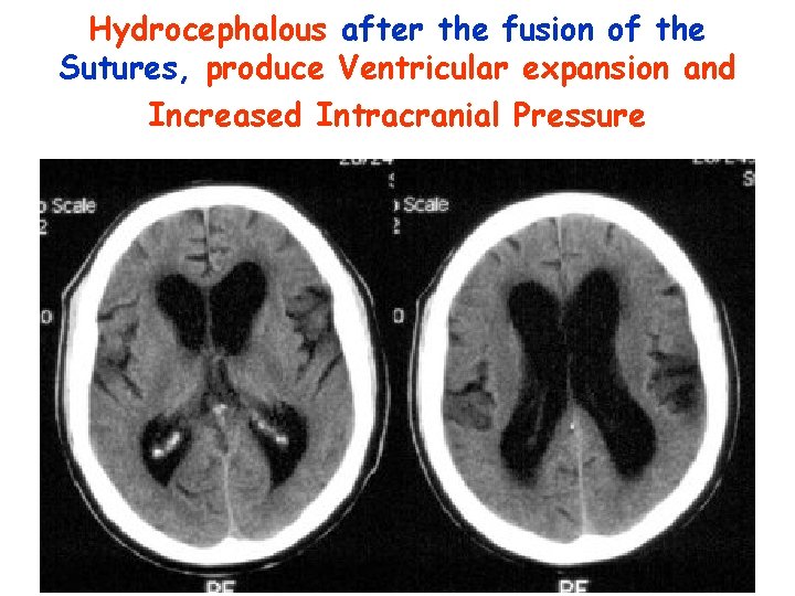Edema Increased water in brain parenchyma Types of