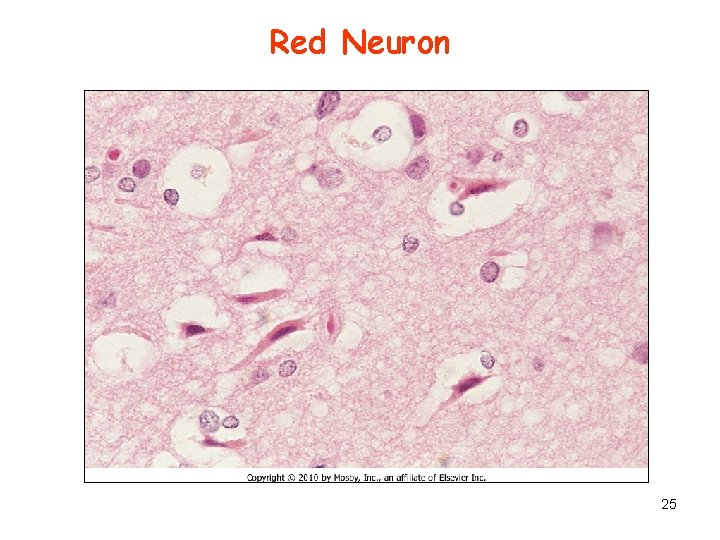 Edema Increased water in brain parenchyma Types of