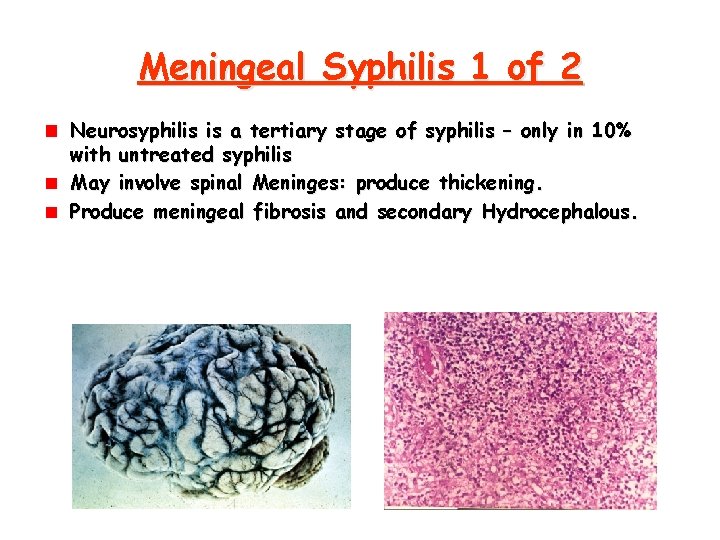 Edema Increased water in brain parenchyma Types of