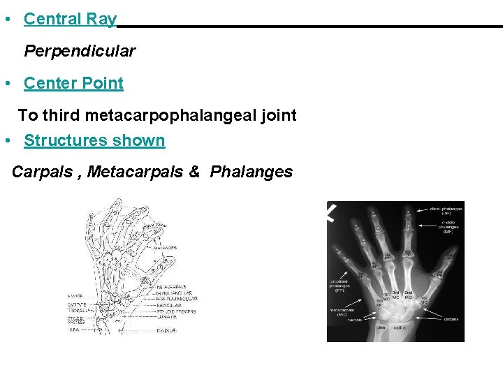 Lecture 5 Radiography of the Upper limbs 1