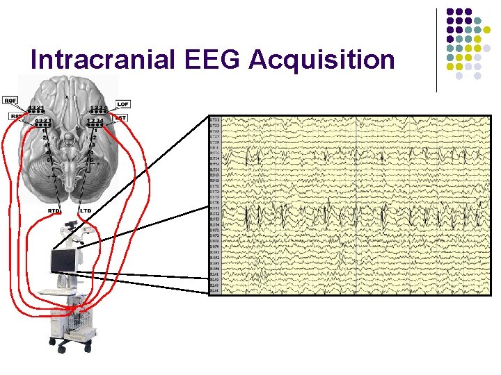 Support Feature Machine for Classification of Abnormal Brain