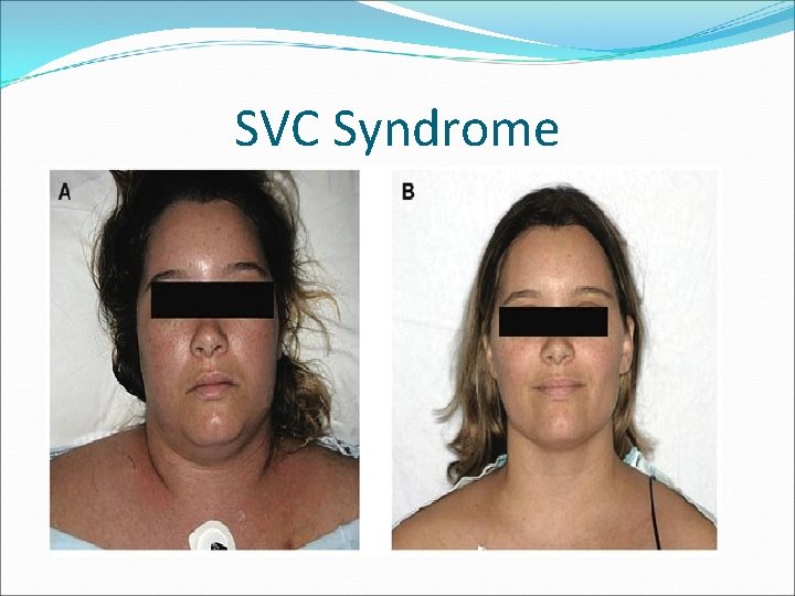 LUNG CANCER Marianna Strakhan MD Attending Physician Department