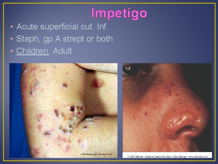 Common skin infection Dr Hend Alotaibi MD Arab