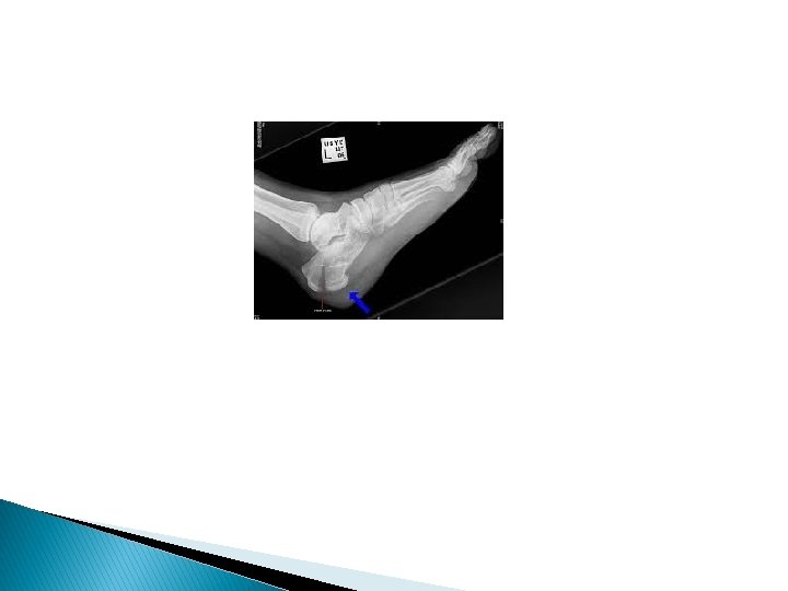 Fracture Talus A talus fracture is a break