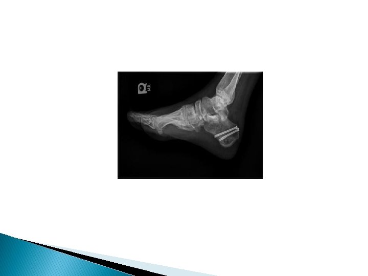 Fracture Talus A talus fracture is a break