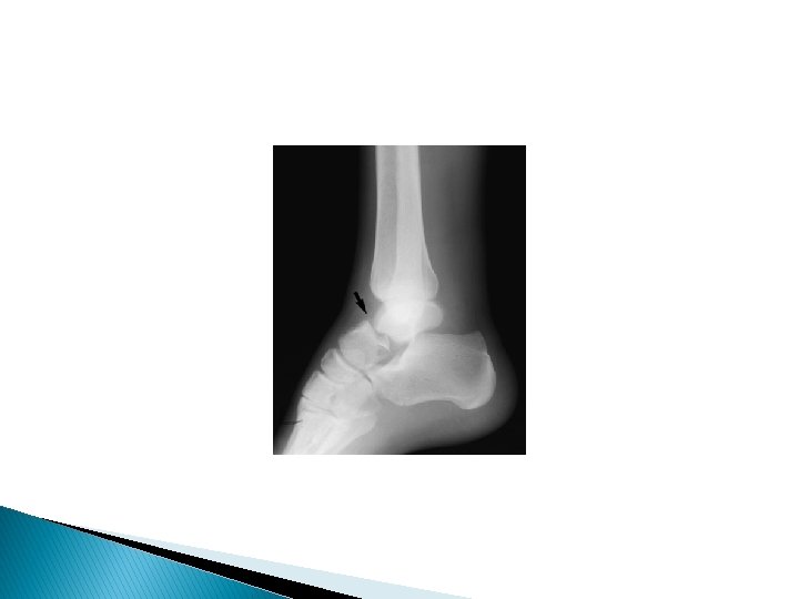 Fracture Talus A talus fracture is a break
