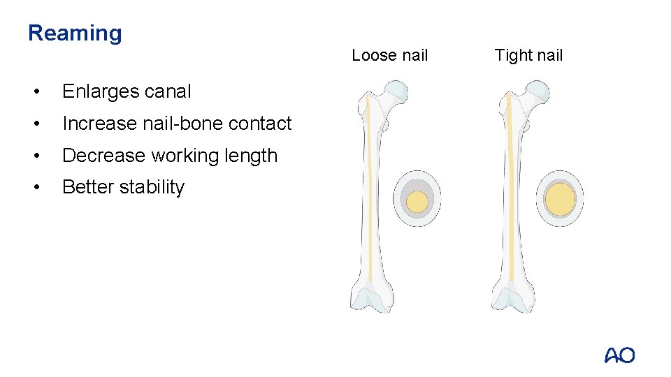 Intramedullary nailing to ream or not to ream