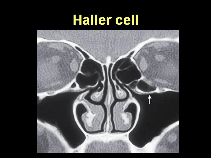 Anatomy of Nose Paranasal Sinuses Dr Vishal Sharma