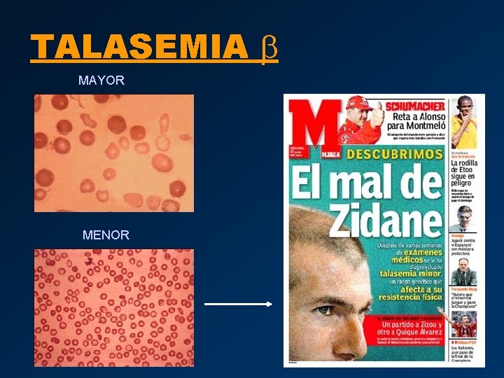 LA TALASEMIA Una enfermedad gentica TALASEMIA alteraciones en