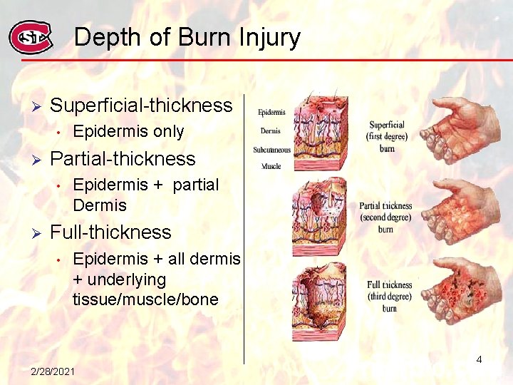 Nursing Care Interventions in the Client with Burn