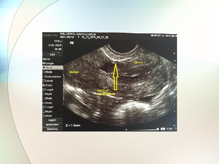 Laparoscopic repair of cesarean scar defect a case