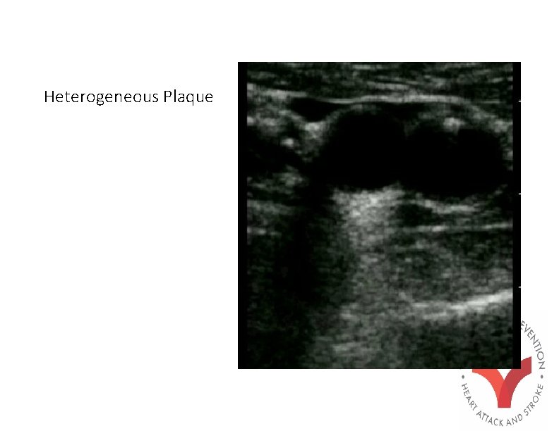 The Center for Prevention Heart Attack and Stroke