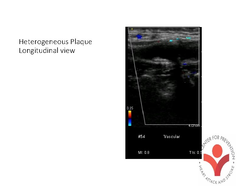 The Center for Prevention Heart Attack and Stroke