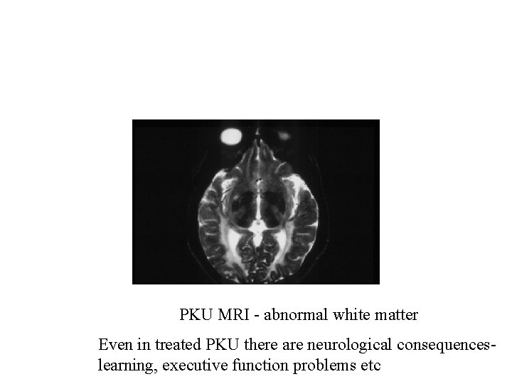 Approach to IEM AA PKU Annette Feigenbaum Division