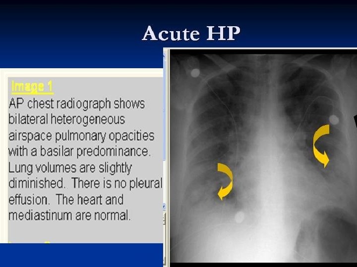 Hypersensitivity Pneumonitis HP By ziba Loukzadeh M D