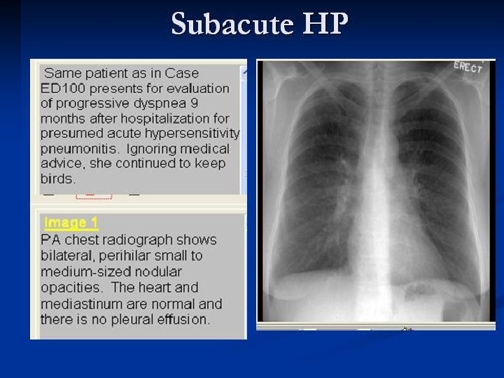 Hypersensitivity Pneumonitis HP By ziba Loukzadeh M D