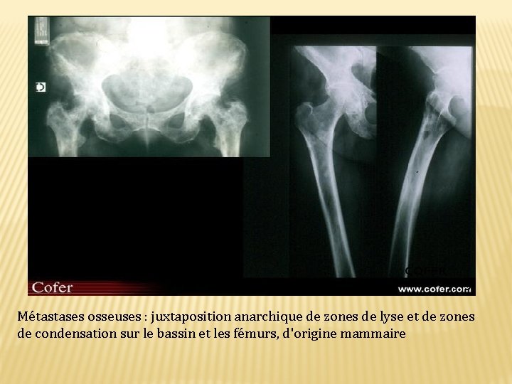 INTERPRETATION DUNE RADIOGRAPHIE EN RHUMATOLOGIE RADIOGRAPHIE STANDARDS Les