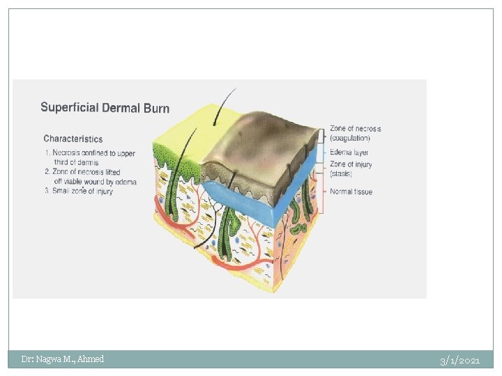 Burn Injuries Its Management BURNS Wounds caused by