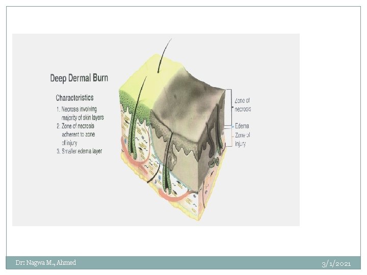 Burn Injuries Its Management BURNS Wounds caused by