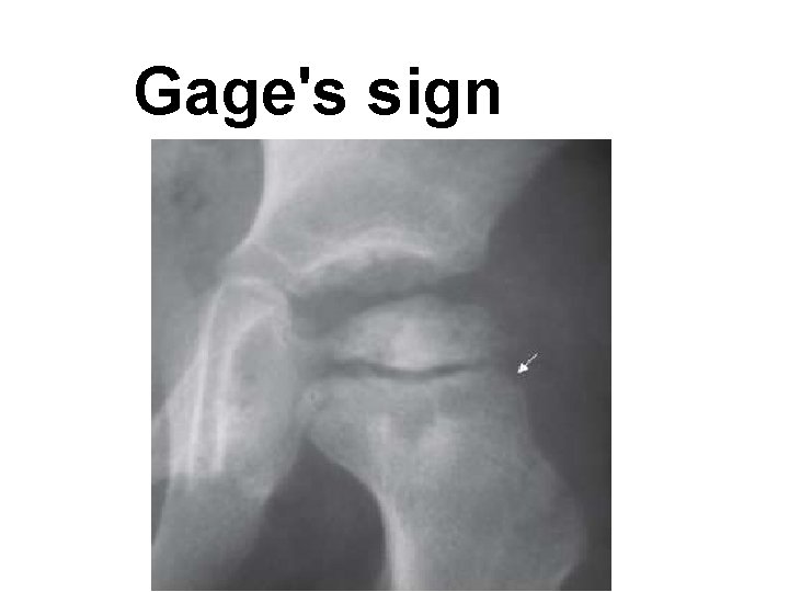 LeggCalve Perthes Disease FIRM 1 GRANDROUND PRESENTERS DR