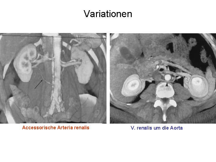 Anatomie der Niere Pelvis renalis Nierenkapsel Befestigung der