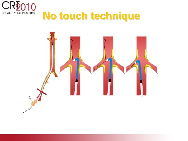 Renal artery interventions Aravinda Nanjundappa MD RVT West