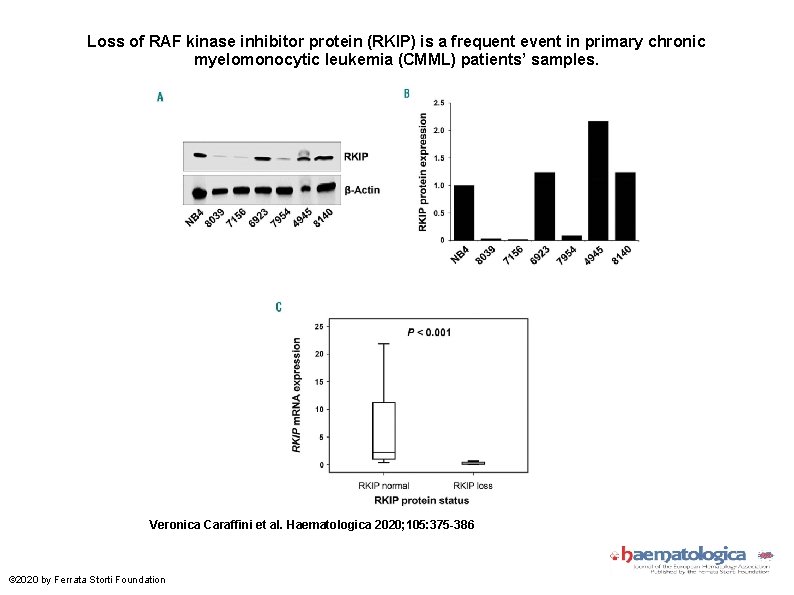 Loss of RAF kinase inhibitor protein is involved