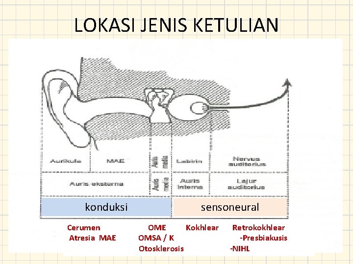 REVIEW pra UTS 1 KELAINAN TELINGA Labirinitis Meniere