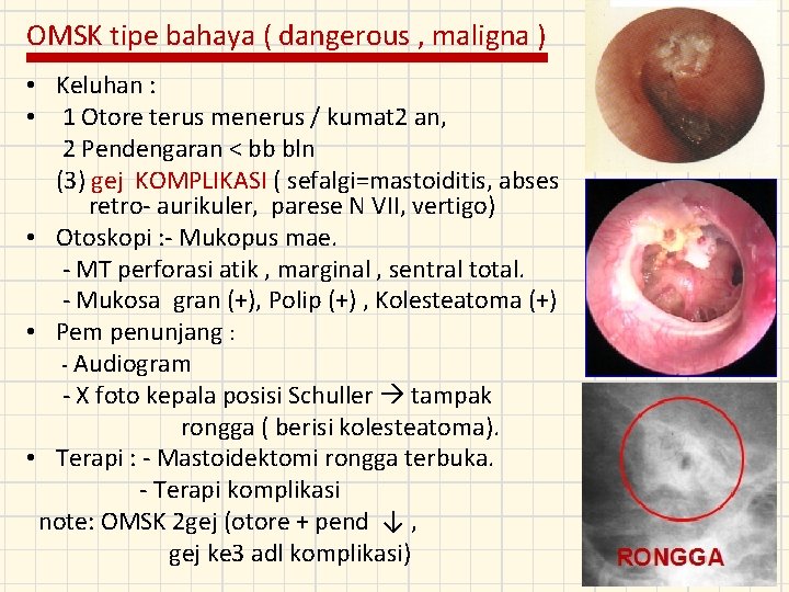 REVIEW pra UTS 1 KELAINAN TELINGA Labirinitis Meniere